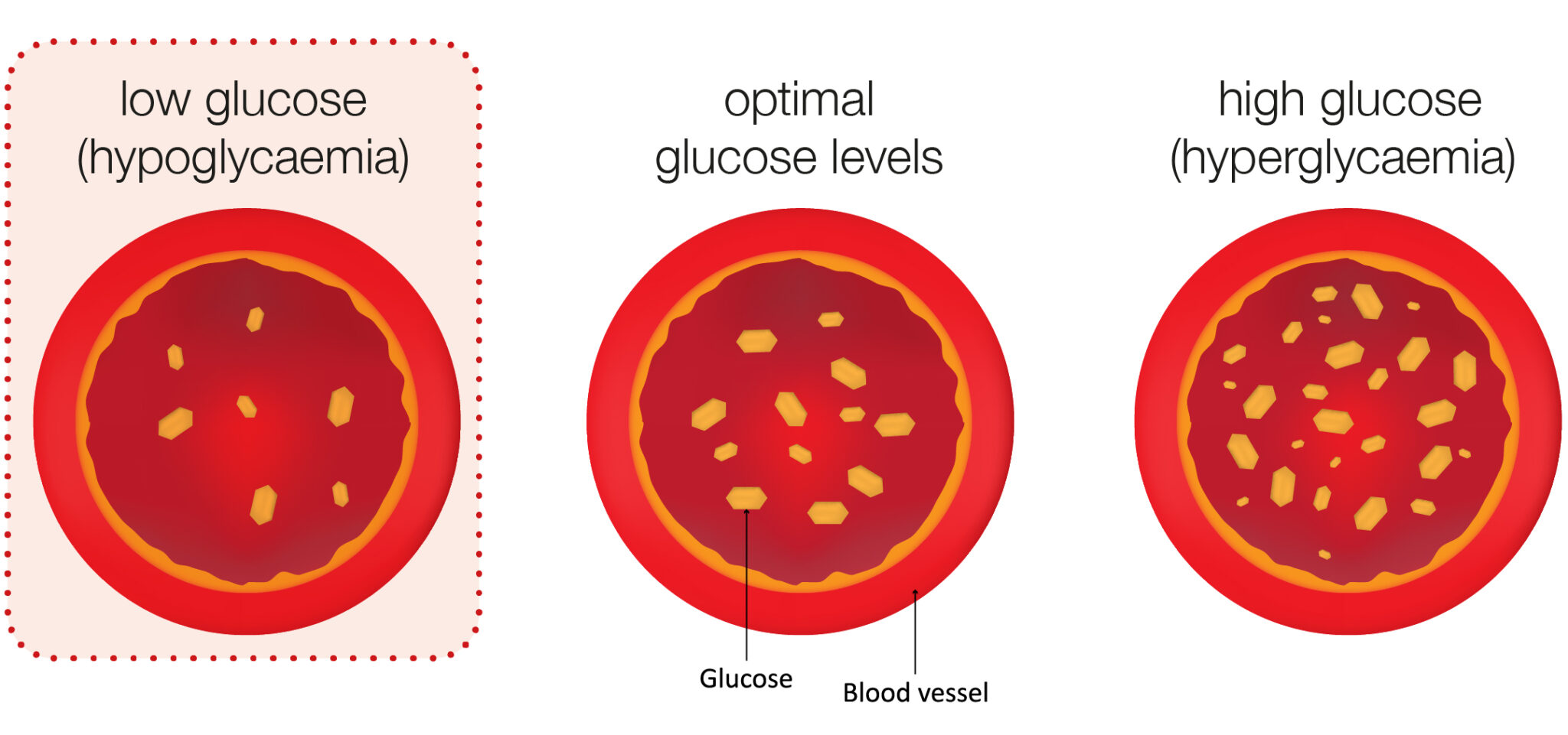 Short Term Complications - Diabetes Education & Information Resource