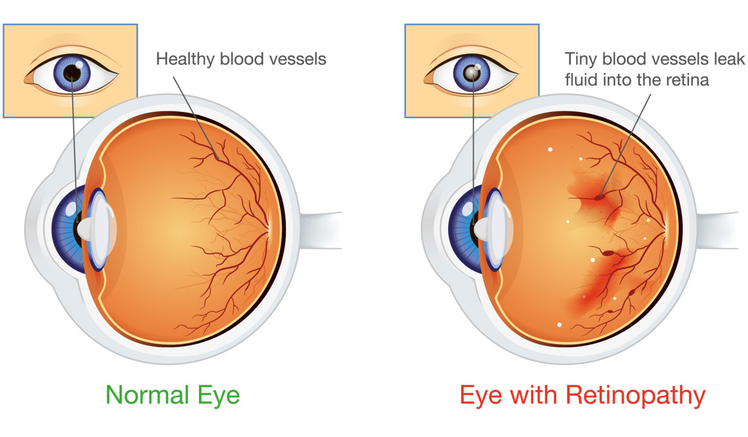 Diabetic Retinopathy & Eye Screening - Diabetes Education & Information ...